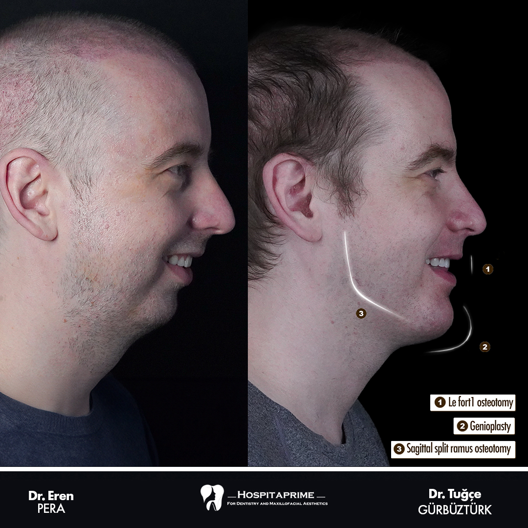 Orthognathic (Jaw) Surgery in Turkey | Hospitaprime
