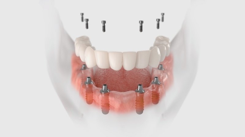 Komple İmplant Diş Tedavisi Nedir? Nasıl Yapılır?
