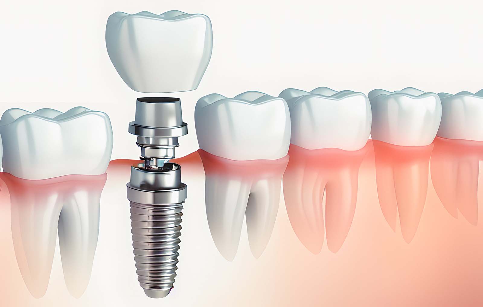 How to Perform Dental Implants for Severe Bone Reseorption