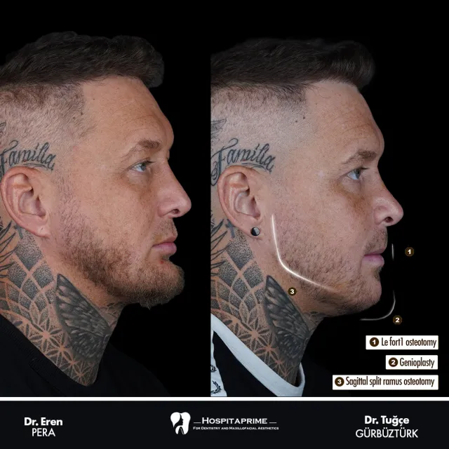 Jaw Surgery Before and After | Stunning Orthognathic Results