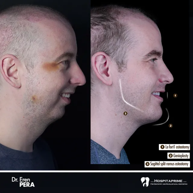Jaw Surgery Before and After | Stunning Orthognathic Results